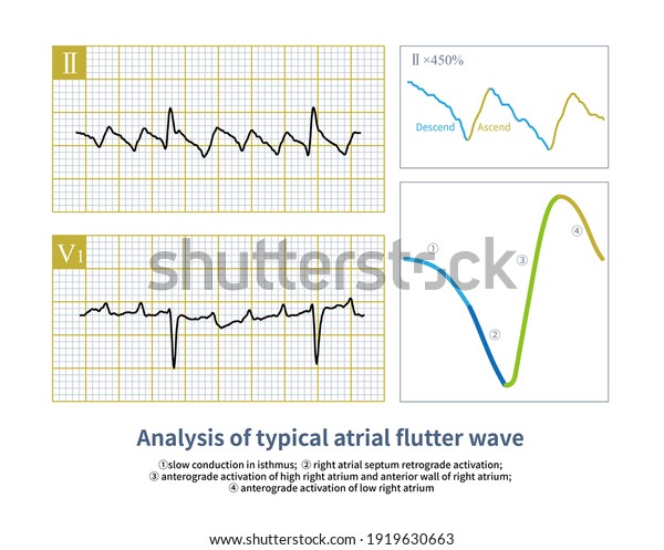 Atrial Flutter Wave Counterclockwise Direction Negative Stock Illustration 1919630663 Shutterstock