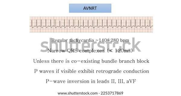 AVNRT의 ECG 기능, SVT의 기준 스톡 일러스트 2253717869 | Shutterstock