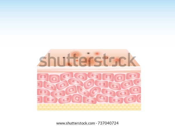 Acne Skin Spot Pimple Problem Vector Stock Vector (Royalty Free ...