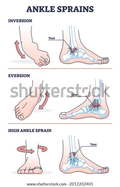 Eversion Of Ankle