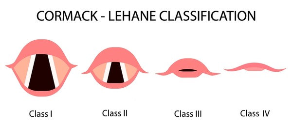 3 en la categoría «Cormack lehane classification» de fotos e imágenes ...