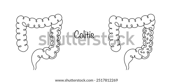 Colitis Acute Chronic Inflammatory Process Large Stock Vector (Royalty ...