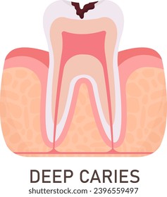 Deep Caries Tooth Problem Vector Illustration Stock Vector (Royalty ...
