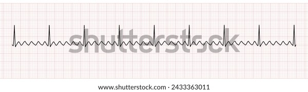 Ekg Monitor Showing Atrial Flutter Stock Vector (Royalty Free ...
