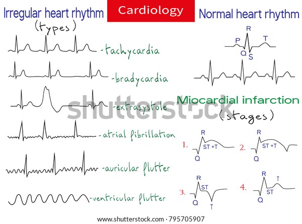 Normal Pathological Ecg Collection Shematic Vector: เวกเตอร์สต็อก (ปลอด ...
