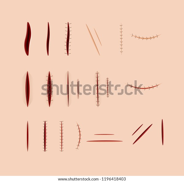 156 Stiches Medical Images, Stock Photos & Vectors | Shutterstock