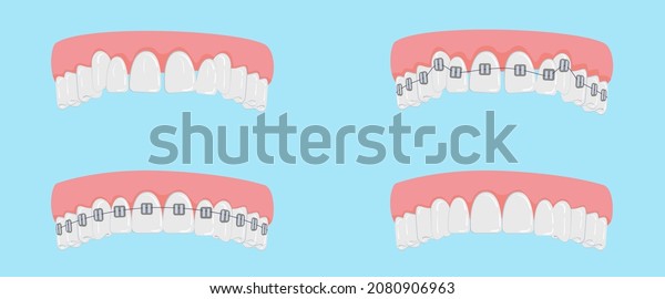 Teeth Alignment Concept Braces Poster Crooked Stock Vector (Royalty ...