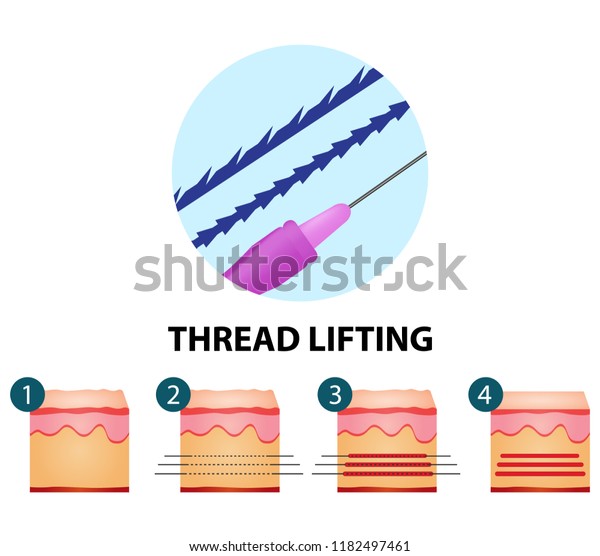 Thread Lifting Vector Illustration Stock Vector (Royalty Free ...