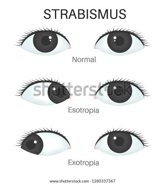 Types Strabismus Stock Vector (Royalty Free) 1280337367 | Shutterstock