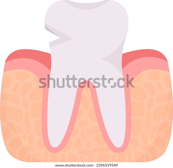Wedgeshaped Defect Tooth Problem Vector Illustration Stock Vector ...