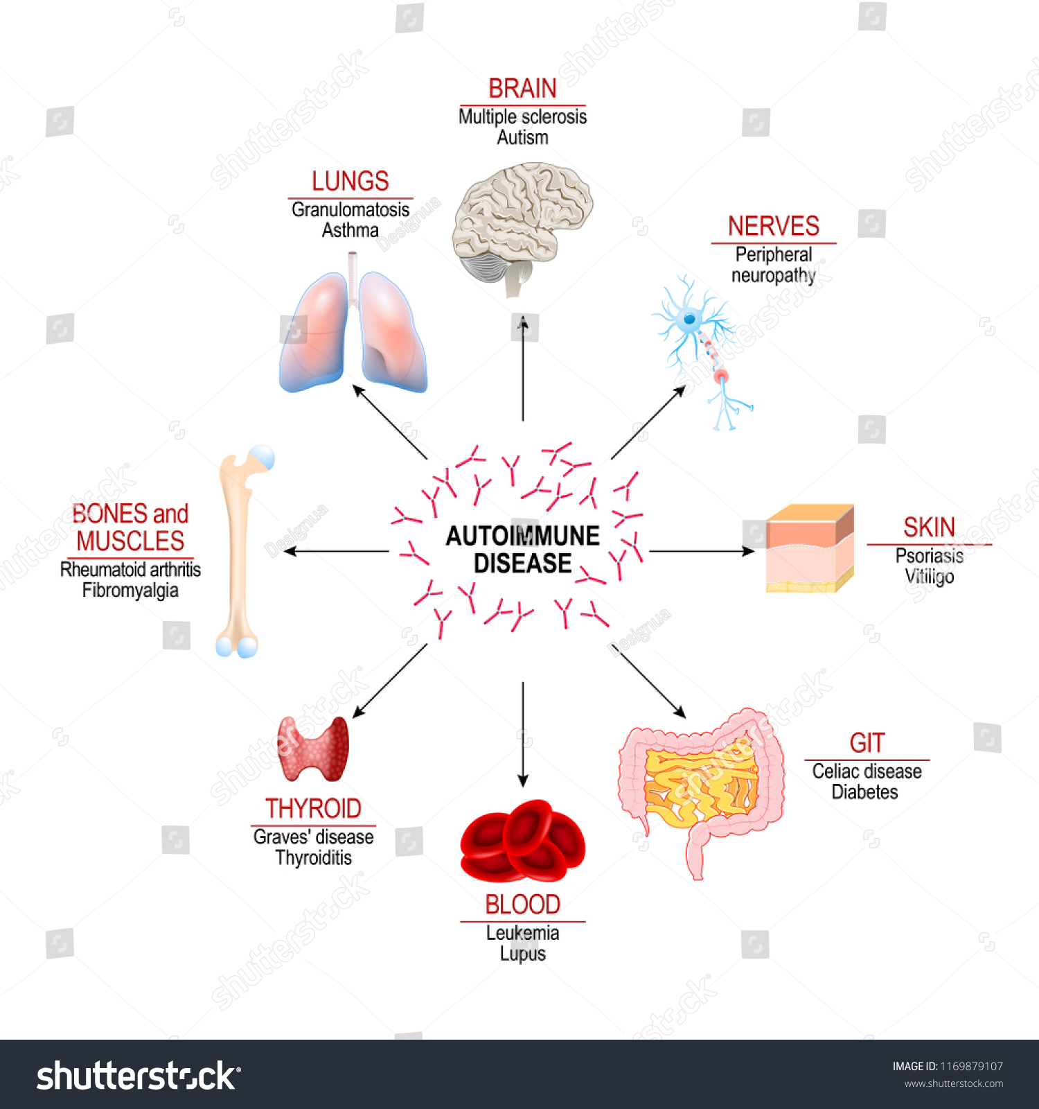 1,433 Lupus Autoimmune Disease Images, Stock Photos & Vectors ...