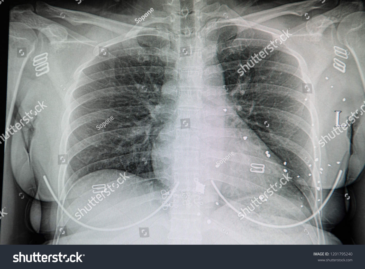 Foreign Bodies Images: Over 371 Royalty-Free Licensable Stock Photos | Shutterstock