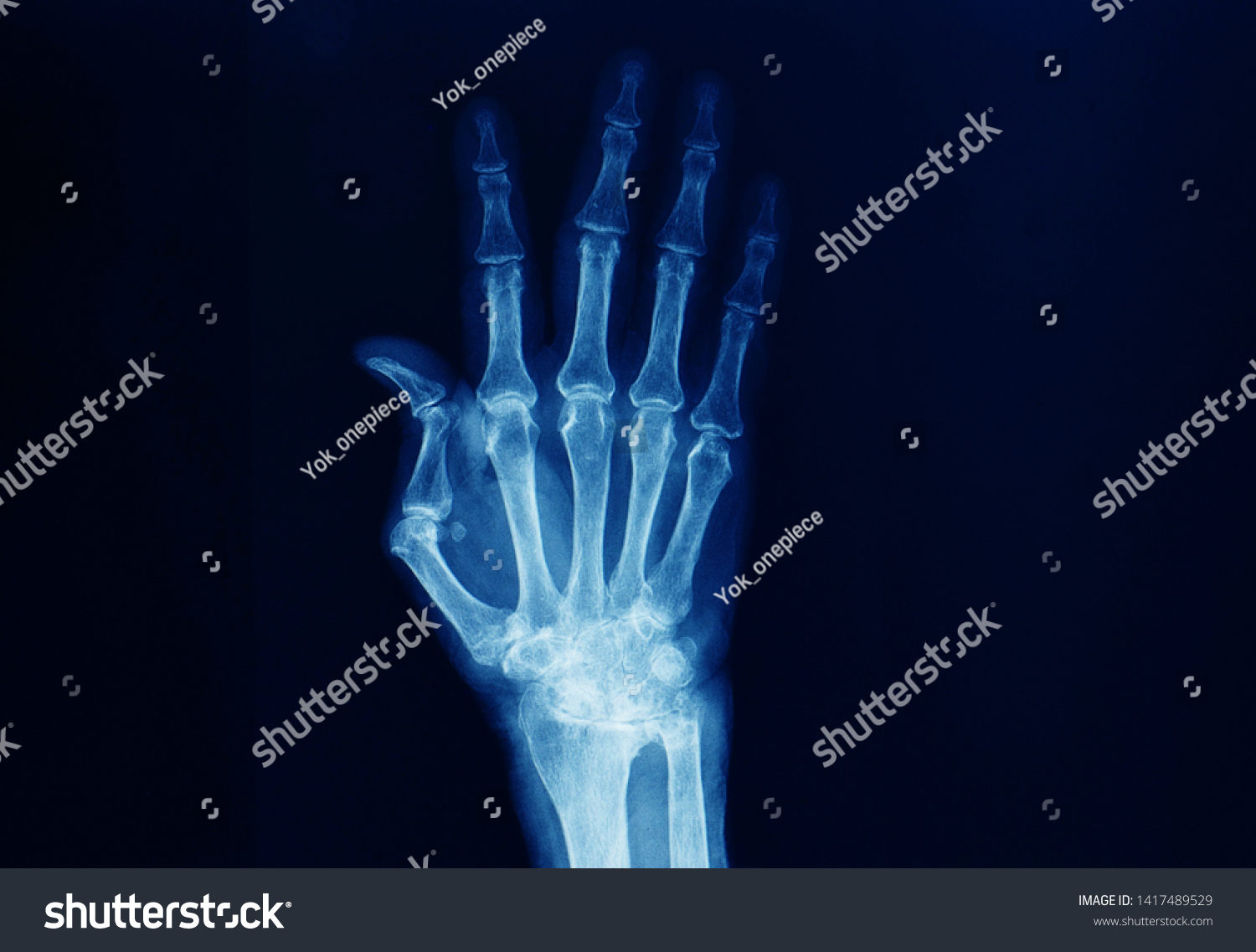 Hand Wrist Xray Showing Severe Arthritis Stock Photo 1417489529 ...