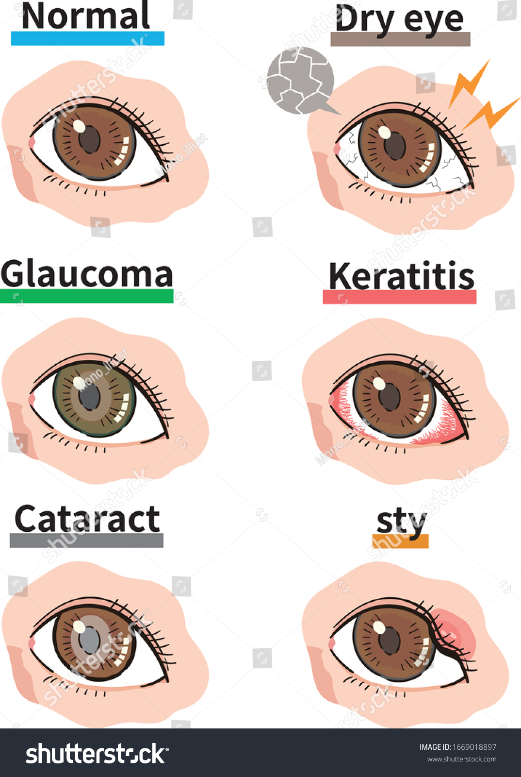 Illustration Various Eye Diseases Stock Vector (Royalty Free ...