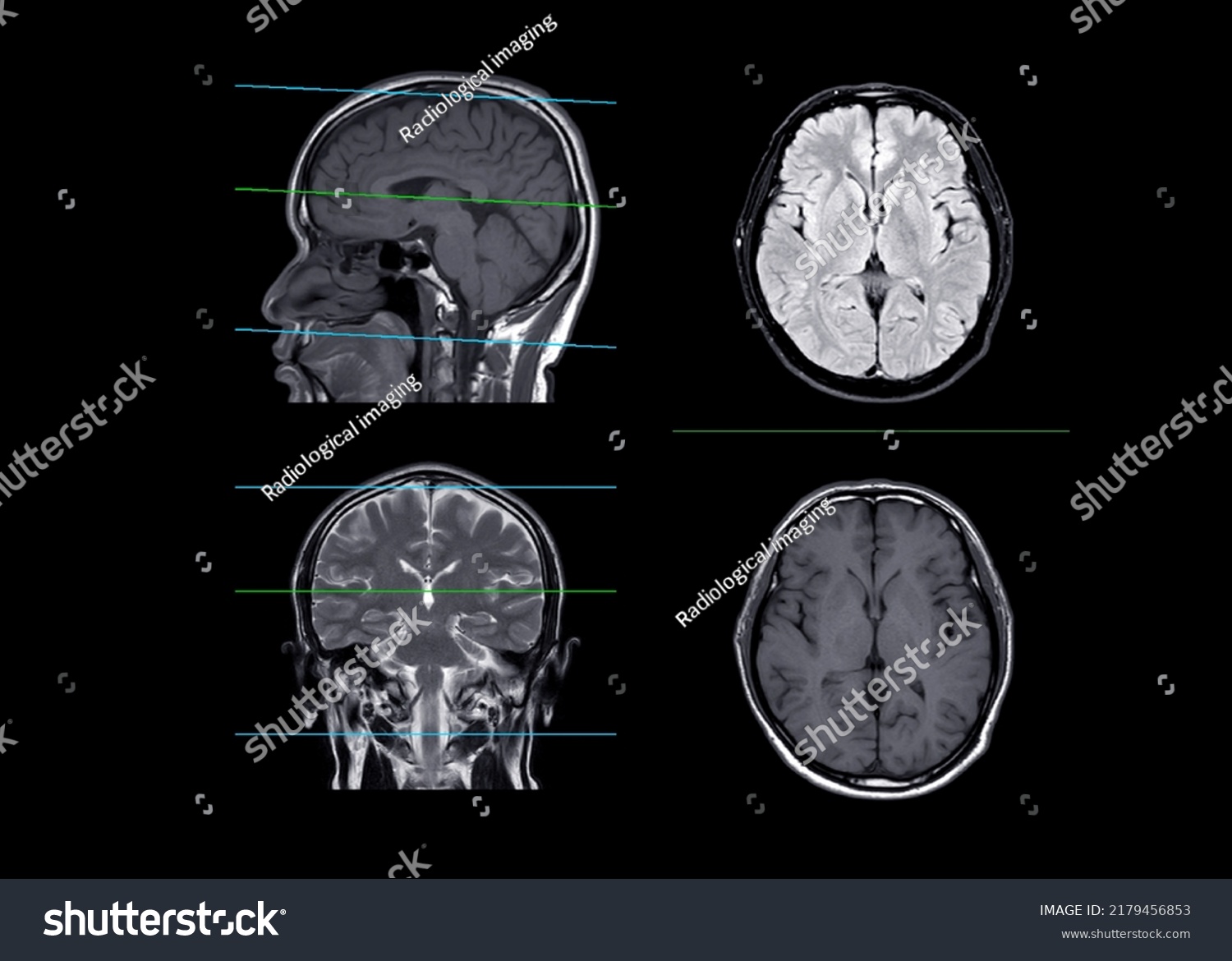 197 Mri Of The Brain Sagittal Plane Images, Stock Photos & Vectors | Shutterstock