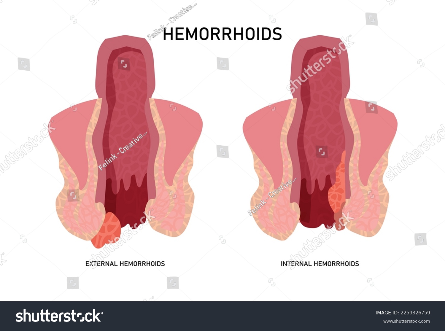 Dos tipos de hemorroides. Nodo hemorroidal: vector de stock (libre de regalías) 2259326759 ...