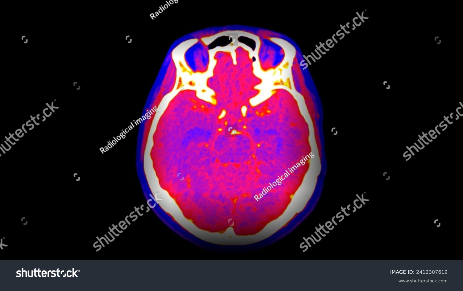 Ct Brain Perfusion Ct Scan Image Stock Illustration 2412307619 Shutterstock