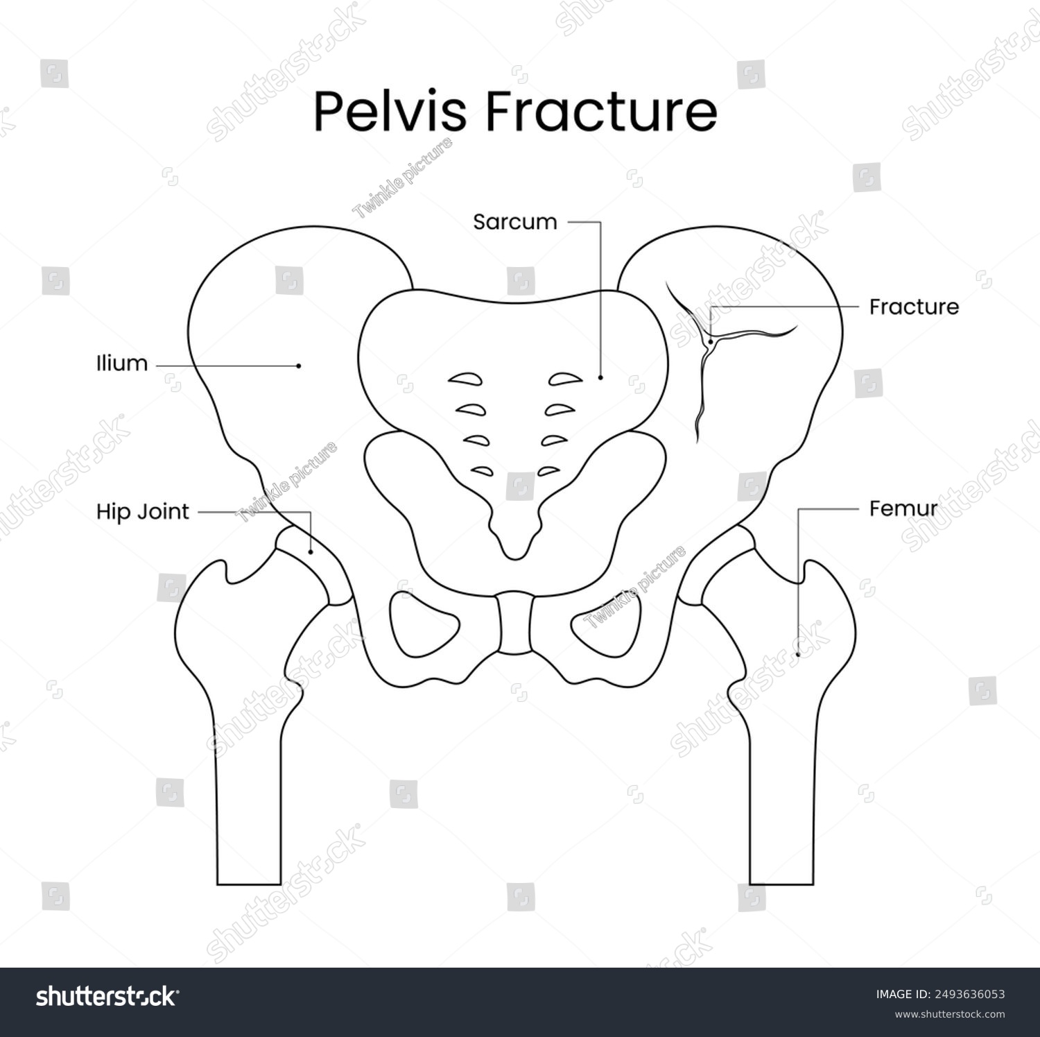 Diagram Pelvis Fracture Sketch Stock Vector (Royalty Free) 2493636053 | Shutterstock