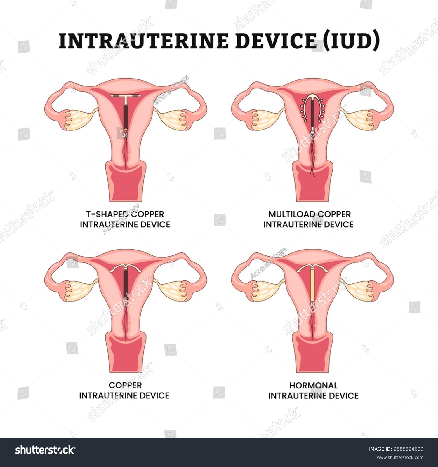 Different Types Iud Intrauterine Device Set Stock Vector (Royalty Free) 2585824609 | Shutterstock