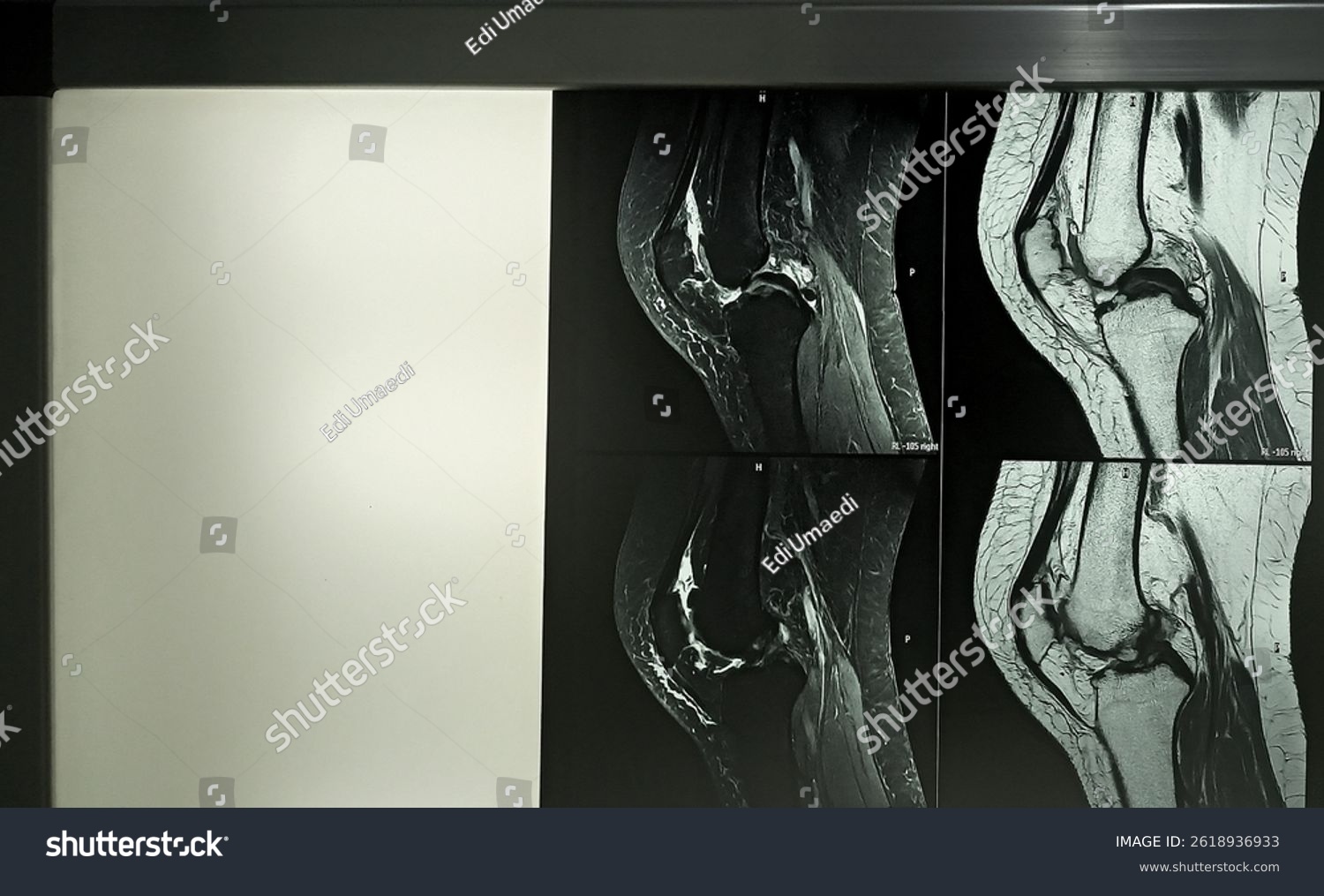 Magnetic Resonance Imaging Knee Joint Mri Stock Photo 2618936933 | Shutterstock